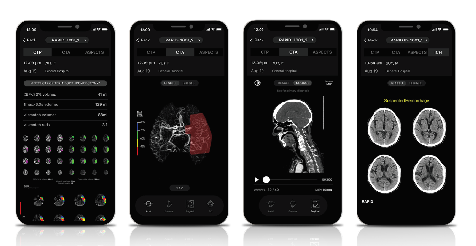 Hospital do ES é pioneiro em software para diagnóstico de AVC | A Gazeta