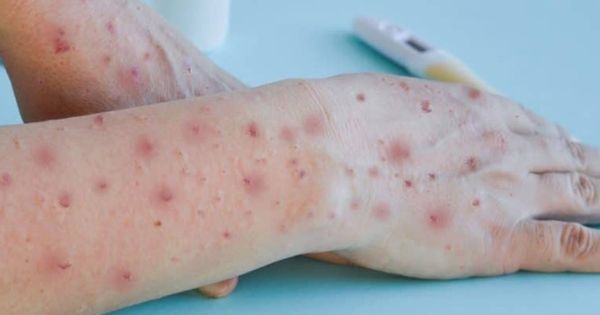 O que se sabe sobre casos de varíola do macaco no ES, no Brasil e no ...