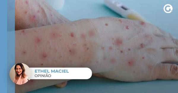 OMS precisa renomear a varíola dos macacos para melhor entendimento da ...