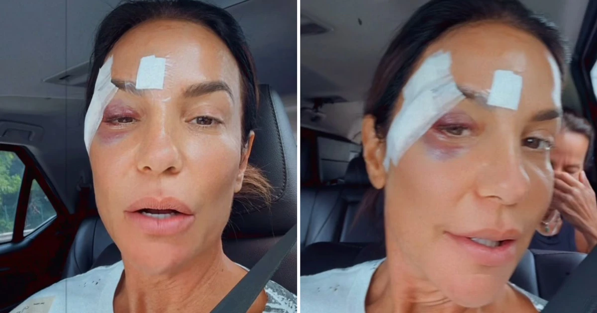 Ivete Sangalo deixa hospital com olho roxo e tranquiliza fãs | HZ